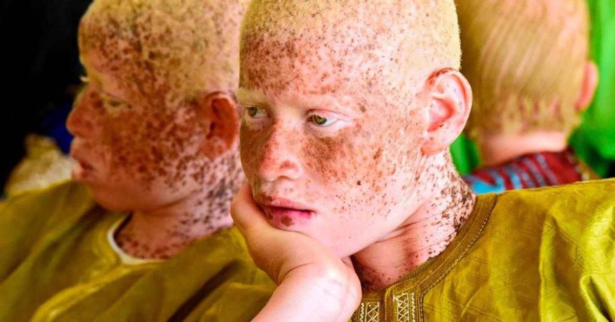 Debunking Common Myths About Albinos: What You Need to Know | Pulse Nigeria